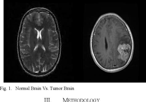 Figure 1 From Brain Tumor Detection Using Xception Model Semantic Scholar