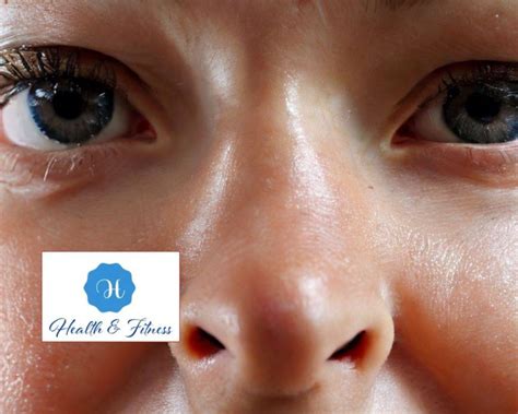 Whiteheads On Nose Causes Prevention And Treatment Options