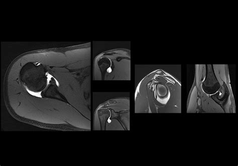 Shoulder Mr Arthrogram E Anatomy