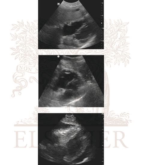 Subxypoid Cardiac View
