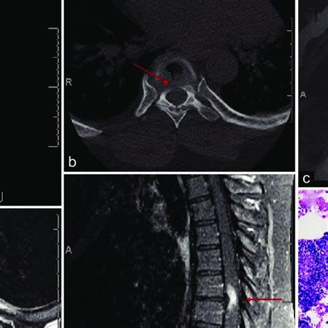 Sagittal A And Axial B Computed Tomography Scan Of The Thoracic Download Scientific Diagram