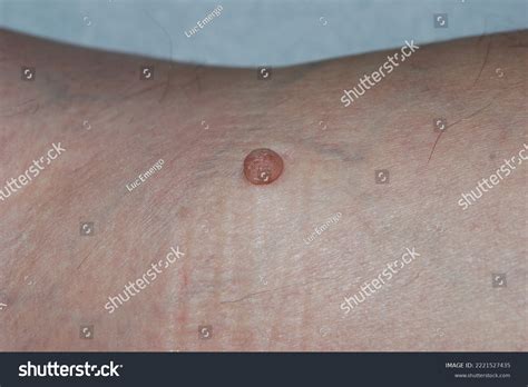 Benign Skin Tumor Benign Skin Tumor