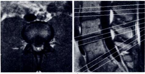 Axial Image Performed By Phase Encoding Along The X Axis See Text Download Scientific