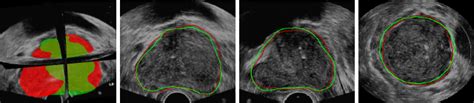 Prostate Segmentation Result Green Line Compared To Manual