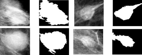 Segmented Malignant Mammograms Download Scientific Diagram