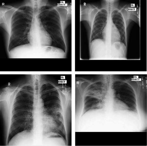 Pre Trained Convolutional Neural Networks As Feature Extractors For Tuberculosis Detection Bohrium