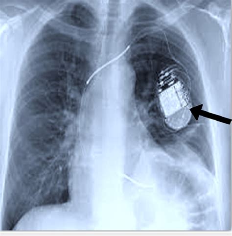 X Ray Showing The Pacemaker In Position Arrow Download Scientific
