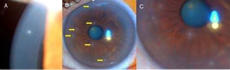 A A Typical Corneal Lesion Of Punctate Keratopathy Of West Indians Download Scientific