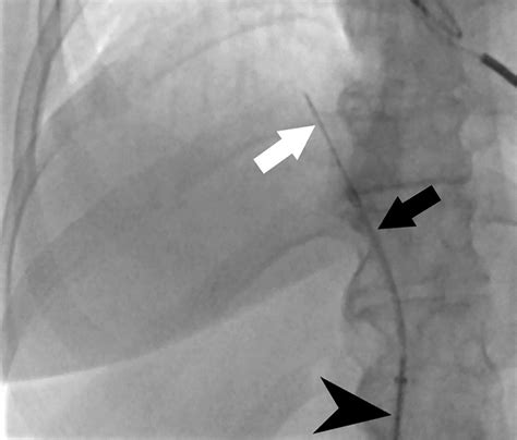 Percutaneous And Transvenous Liver Biopsy Applied Radiology