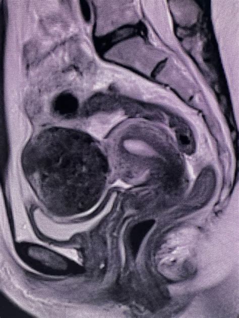 Fibroid Position Make A Difference R Fibroids