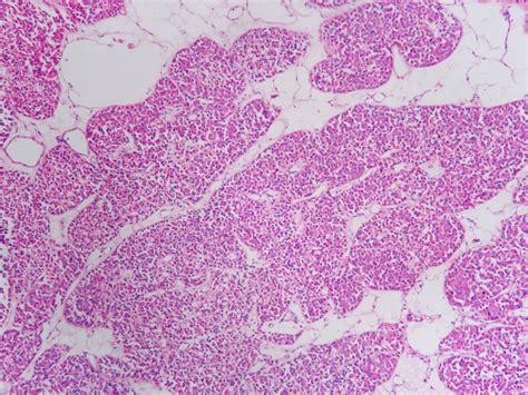 Oncocytoma Histopathology Guru