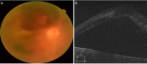 Ruptured Retinal Arterial Macroaneurysm The Fundus Photograph Shows Download Scientific