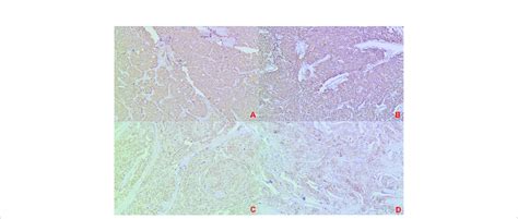 Recurrence Treatmentimmunohistochemical Staining A Download