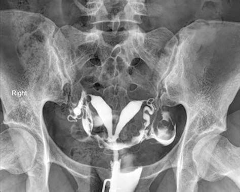 Hysterosalpingogram Hsg Test In Chennai