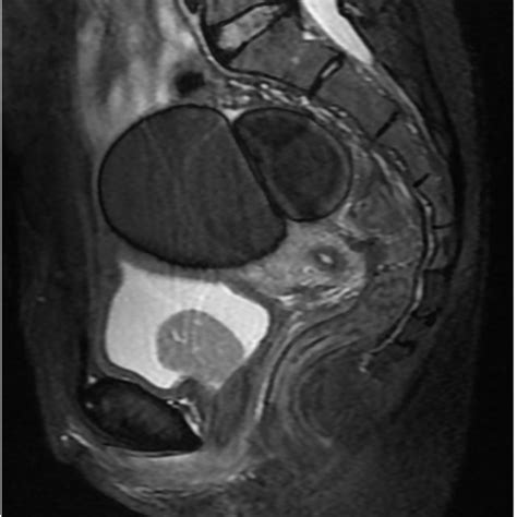 Mri Showing The Presence Of An Oval Shaped Mass Lesion Arising From The