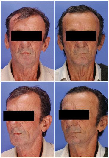 Rbcp Use Of Bernard Webster Flap For Lower Lip Reconstruction After
