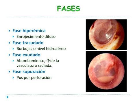 Otitis Media Aguda