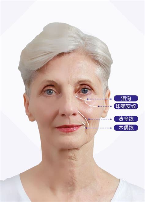 博恩｜空塌型印第安纹带来的憔悴感，看专业团队如何解决？ 知乎