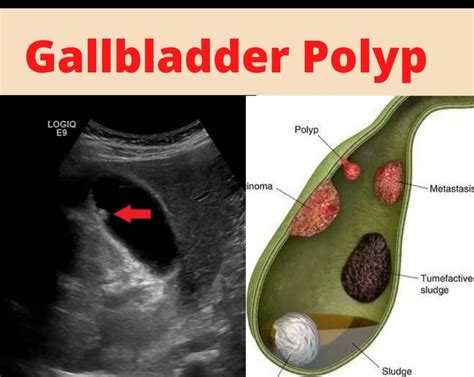 Dare Gallbladder Polyp A Gallbladder Polyp Is A
