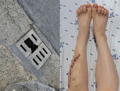 아이 안은 엄마 깨진 하수구 밟고 24바늘 꿰맸는데배상 못해