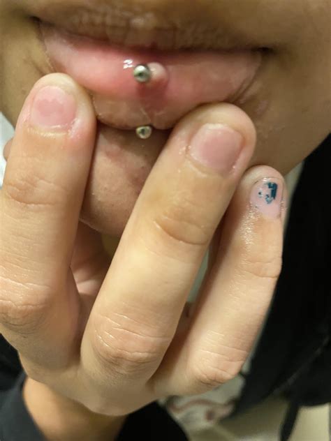 Ashley Piercing Keloid Ive Had It Since January And Recently The