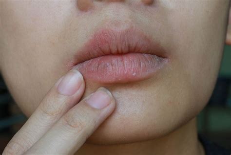 What Is Angular Cheilitis Health And Detox And Vitamins