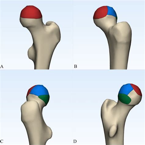 Ficat And Arlet Classification 32 Modified For Osteonecrosis Download Scientific Diagram