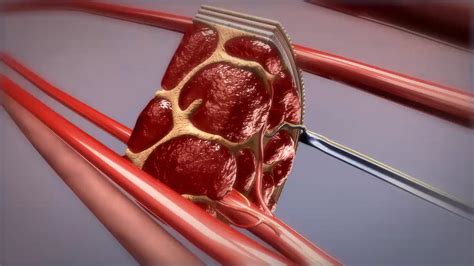 Medical Animation From Visual Health Solutions