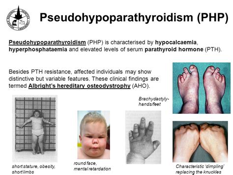 Pseudohypoparathyroidism