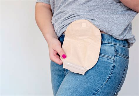 Watch For These Most Common Complications Of An Ileostomy