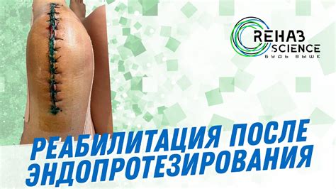 Реабилитация после эндопротезирования коленного сустава - YouTube