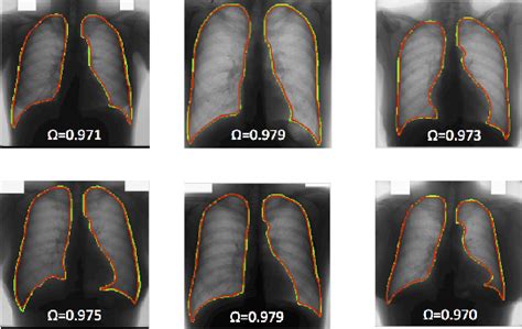 Figure 1 From Lung Segmentation In Chest Radiographs Using Distance Regularized Level Set And