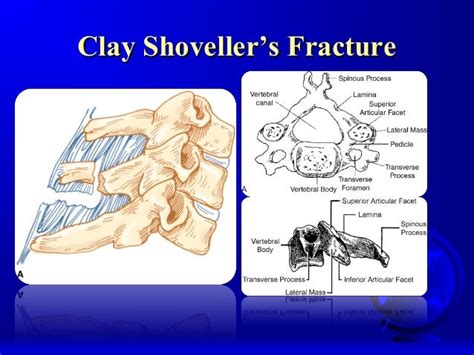Clay Shovelers Fracture