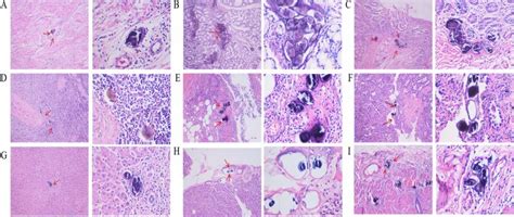 Schistosoma Eggs Deposition In The Organs Of The Digestive System A