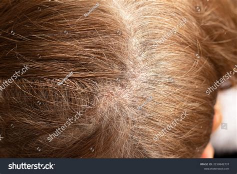 Itchy Scalp Bumps Images Stock Photos Vectors Shutterstock
