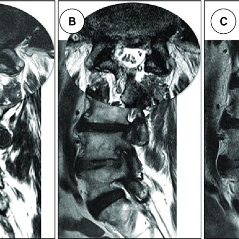 Additional Foraminal Decompression For Remnant Foraminal Stenosis A
