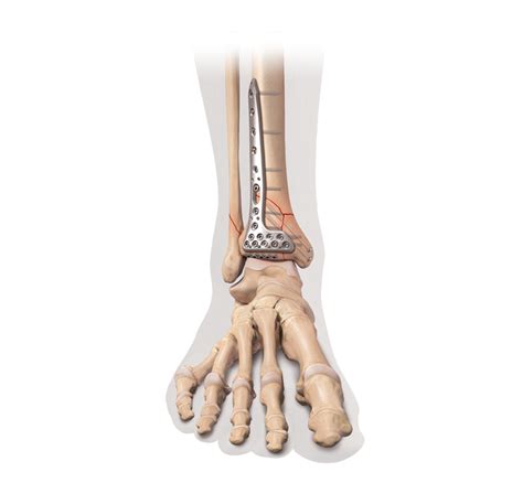 Distal Tibia Fracture