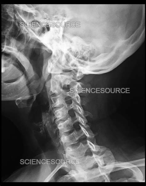 Cervical Spine X Ray Normal Webhostingress