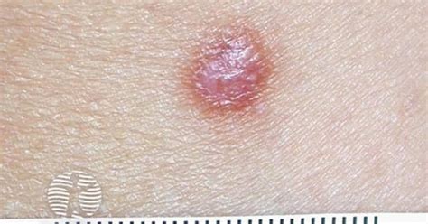 Dermatofibroma Image