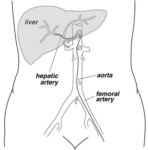 Your Hepatic Artery Embolization Treatments Patients And Families Uw Health