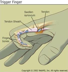 Trigger Finger Treatment Options Causes