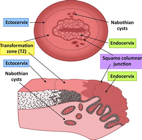 Cervical Cancer Causes Symptoms And Signs Treatment