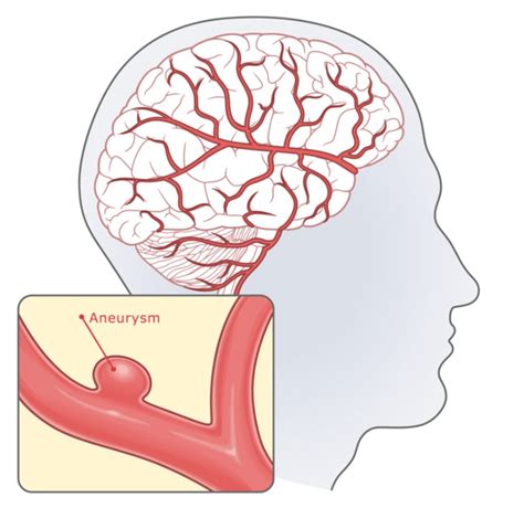 Common Brain Disorders And Brain Aneurysms Early Warning Signs And