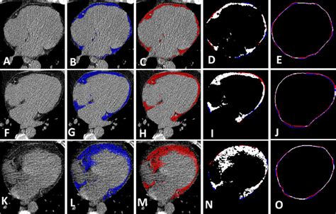 Automated Segmentation Of Epicardial Adipose Tissue Eat Axial Download Scientific Diagram