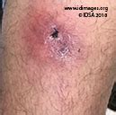 Pythium Images Infectious Disease Images EMicrobes Digital Library Atlas