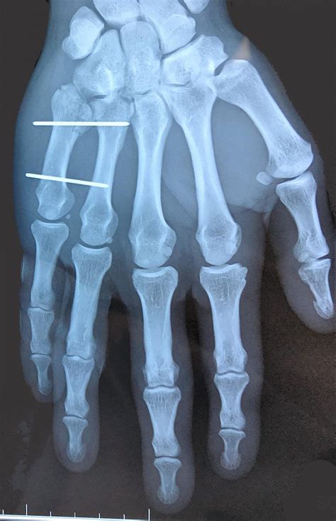 Fracture Base 5eme Metacarpien Broches Linstitut De Chirurgie De La