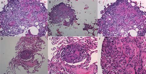 A B C Lung Biopsy Findings Showing Non Caseating Granulomas D E Download Scientific