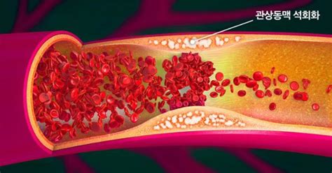 운동하면 좋다는데 2만5000명 5년간 추적해보니