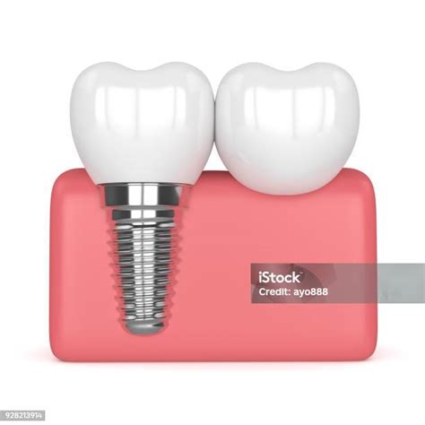 임 플 란 트 치과 외팔보 다리와의 3d 렌더링 3차원 형태에 대한 스톡 사진 및 기타 이미지 3차원 형태 건강관리와 의술 관교의치 Istock
