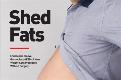 Esg A New Weight Loss Procedure Without Surgery Prime Magazine